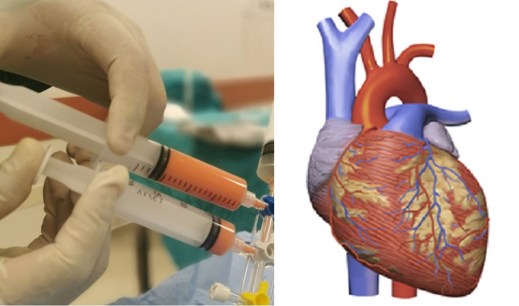 Injecția de celule stem, noua armă împotriva insuficienței cardiace